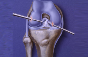 ACL Arthritis