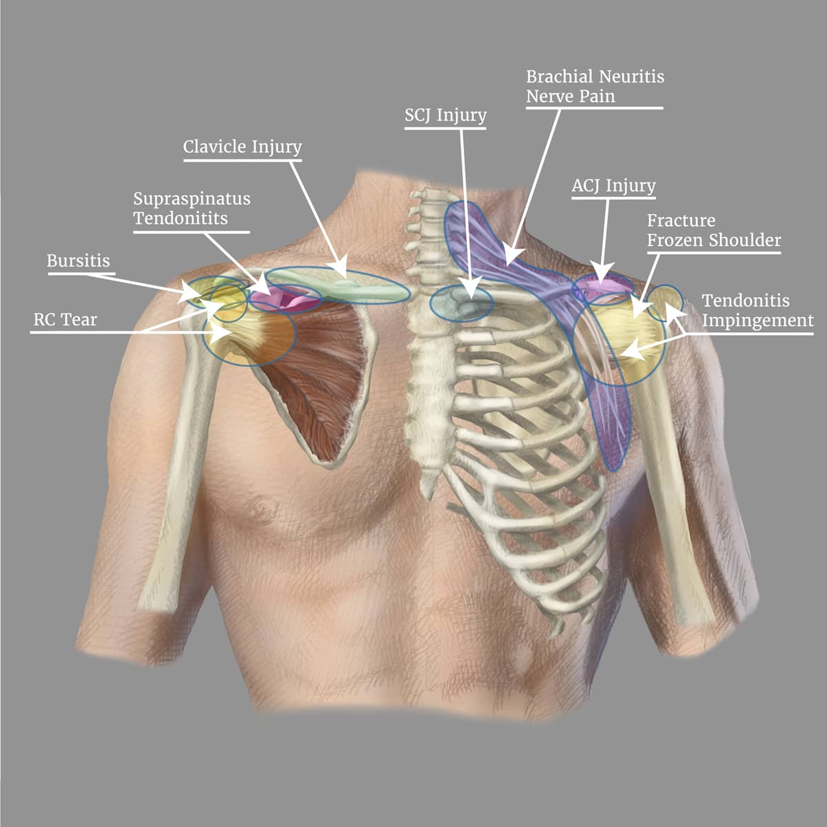 When To Have Shoulder Surgery