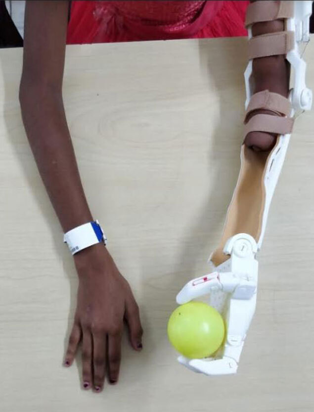 3D-printed limbs give disabled a helping hand (and leg) | India News ...