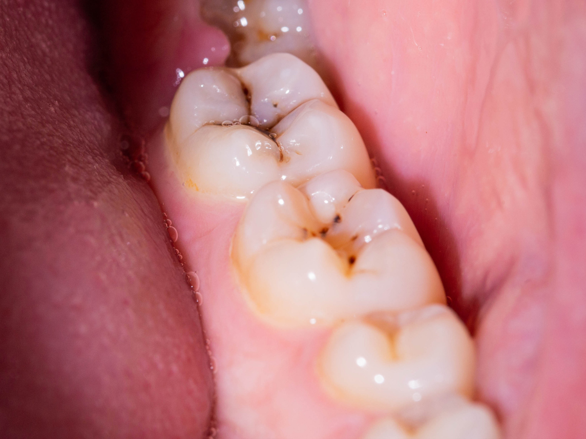 Ignoring toothache for long? Here's why you should never do so