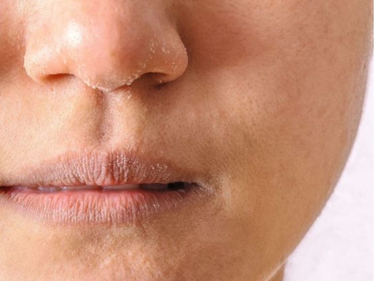 Flaky Skin Skin Peeling: 9 Reasons Your Skin Is Peeling (with