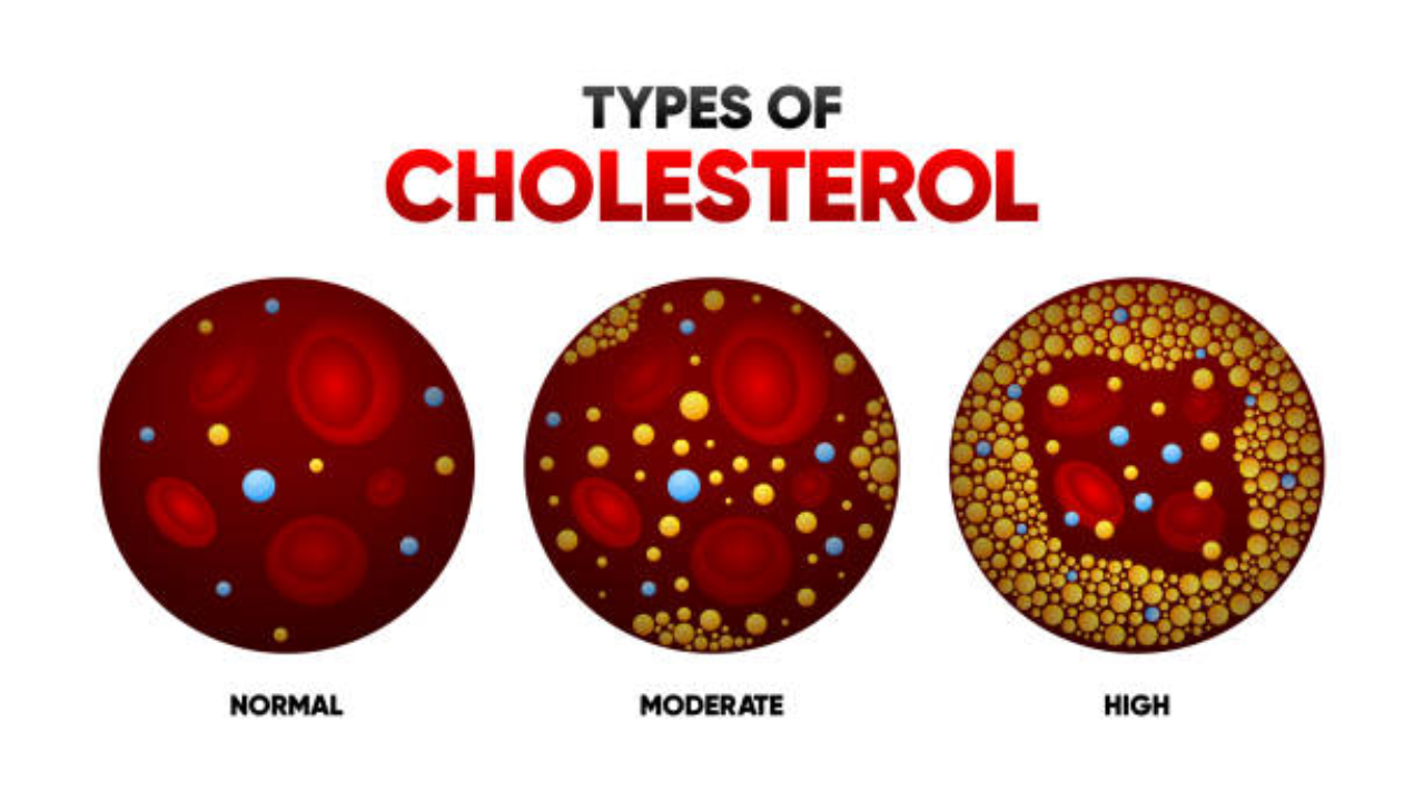 Can high cholesterol alone give you a heart attack?…
