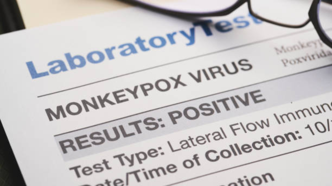 Monkeypox can spread like COVID through close contact:…