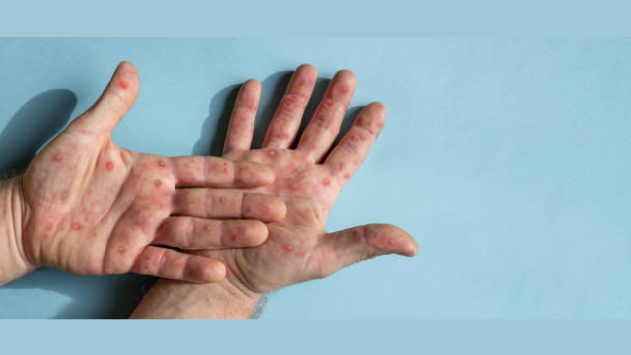 Monkeypox in India: 26 year old man from Haryana tests…