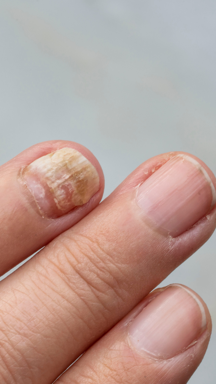 Vitamin Deficiency Fingernails