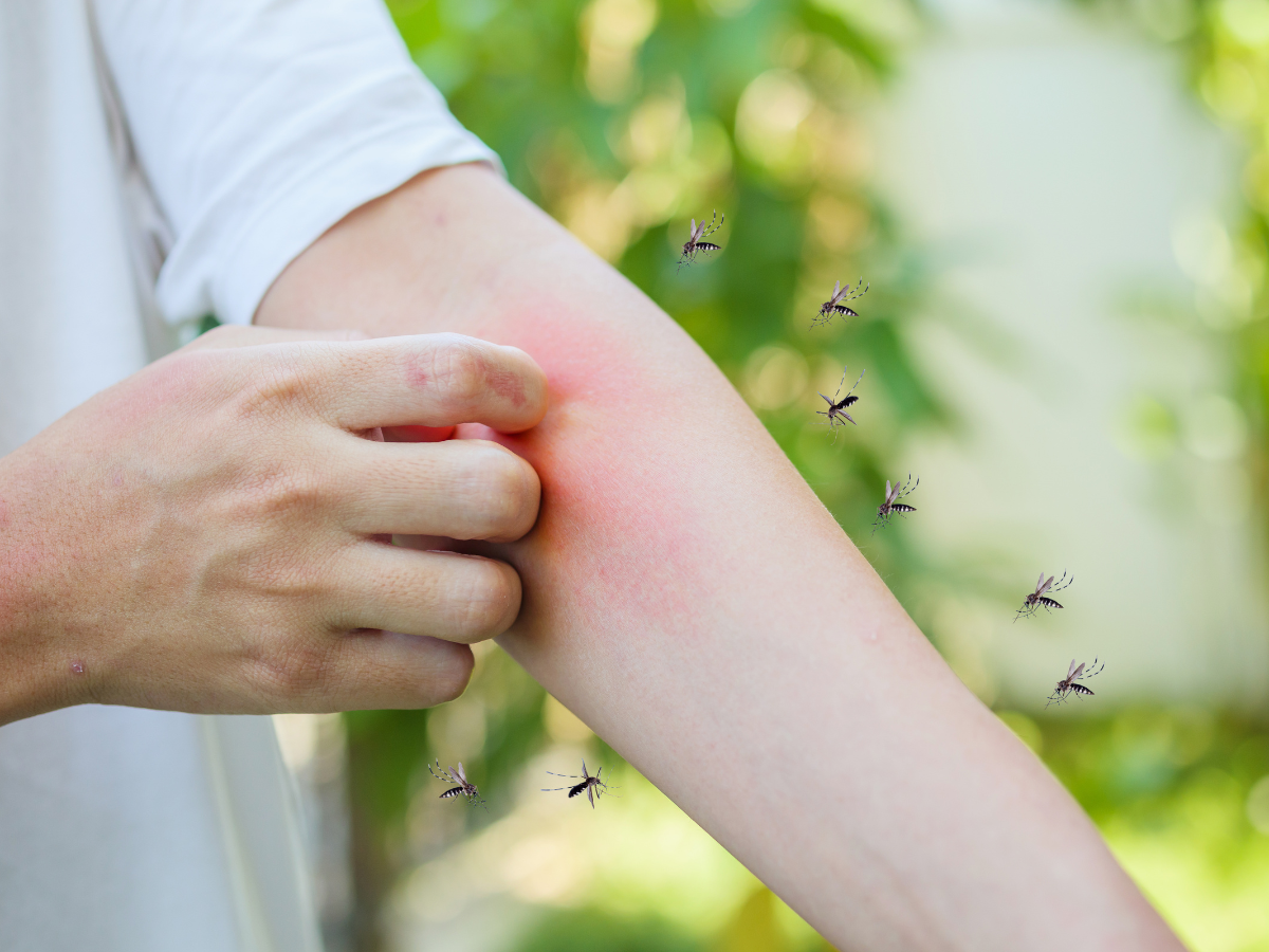 Itch, fever, or worse? Can mosquito bites trigger severe allergic ...