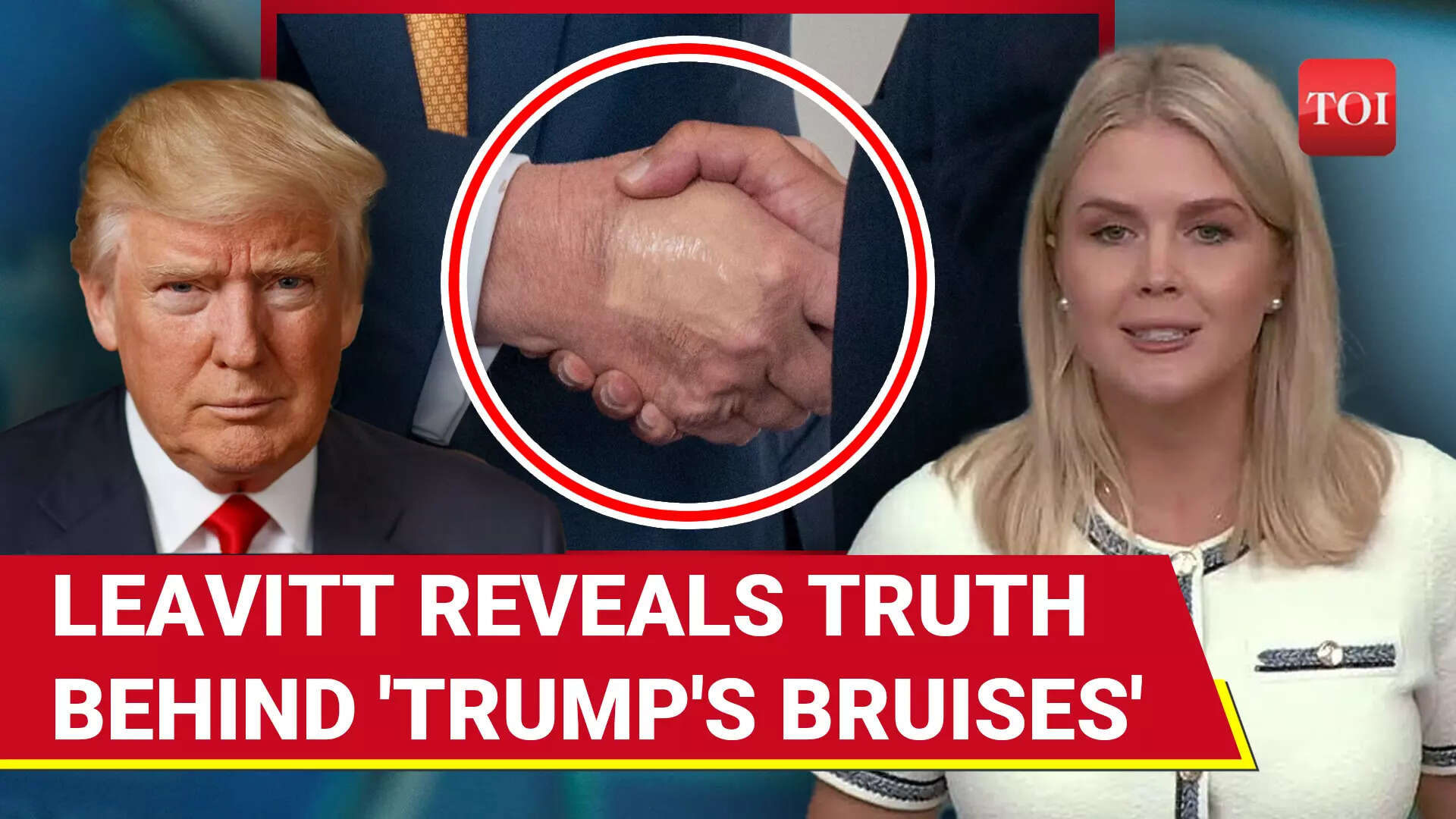 Trump Leg Swelling: Leavitt Scrambles To Explain 'Chronic Venous ...