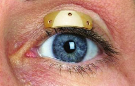 Gold weights on eyelids help cure facial deformity