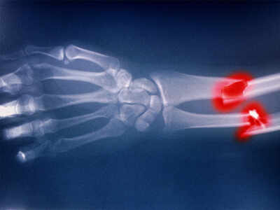 Bone fracture may lead to body pain