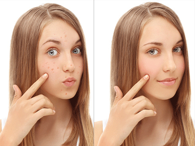 How to heal acne scars