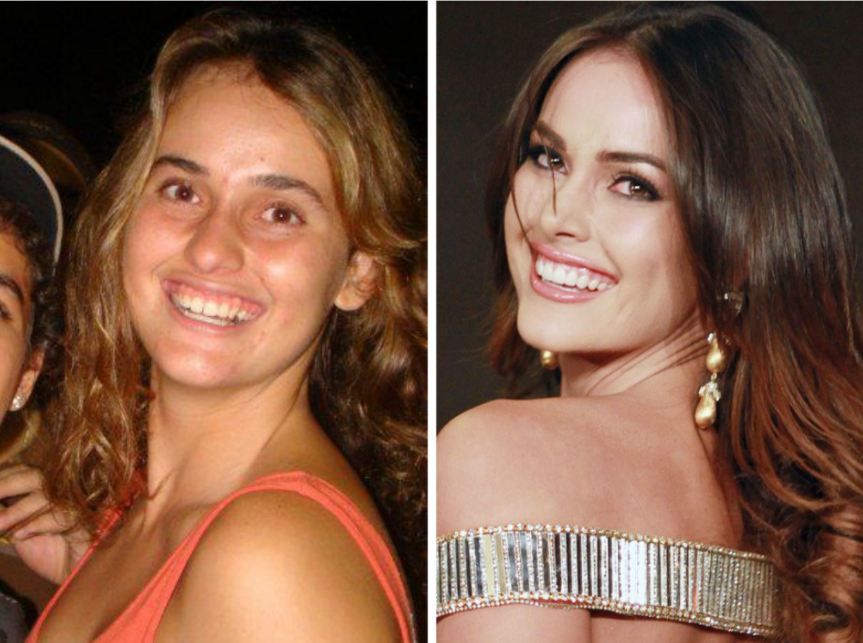 Beauty queens who did plastic surgery