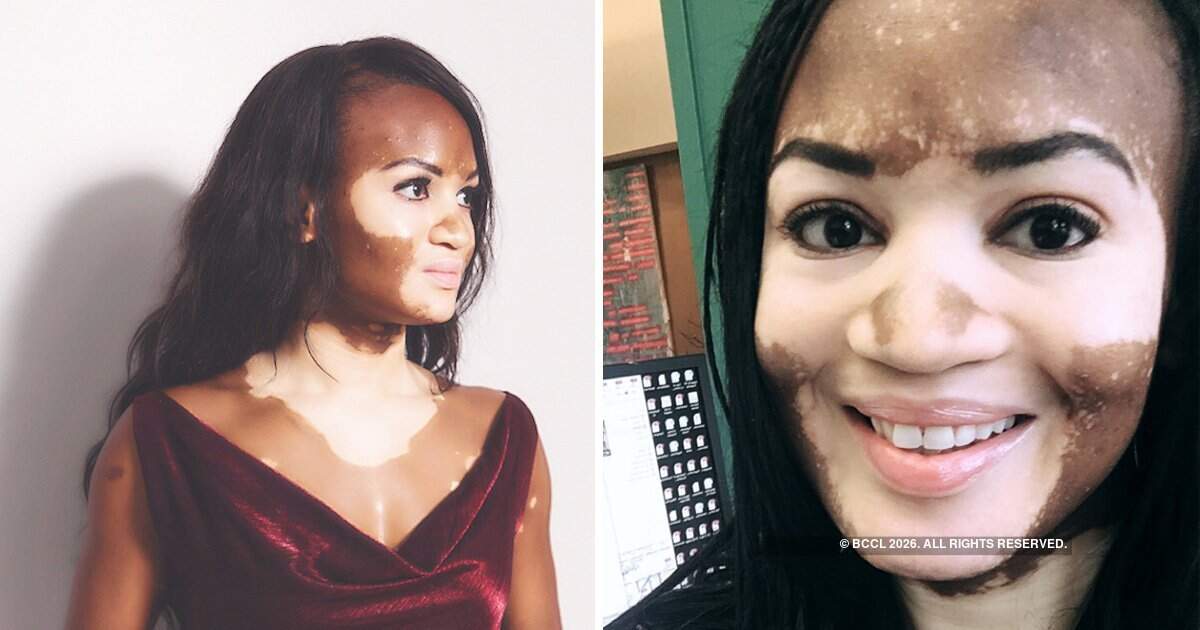 A model revealed her rare skin condition in a moving post about self love