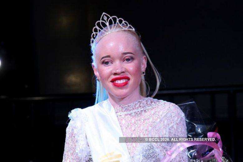 Miss Albinism beauty pageant crowns first winner in Zimbabwe