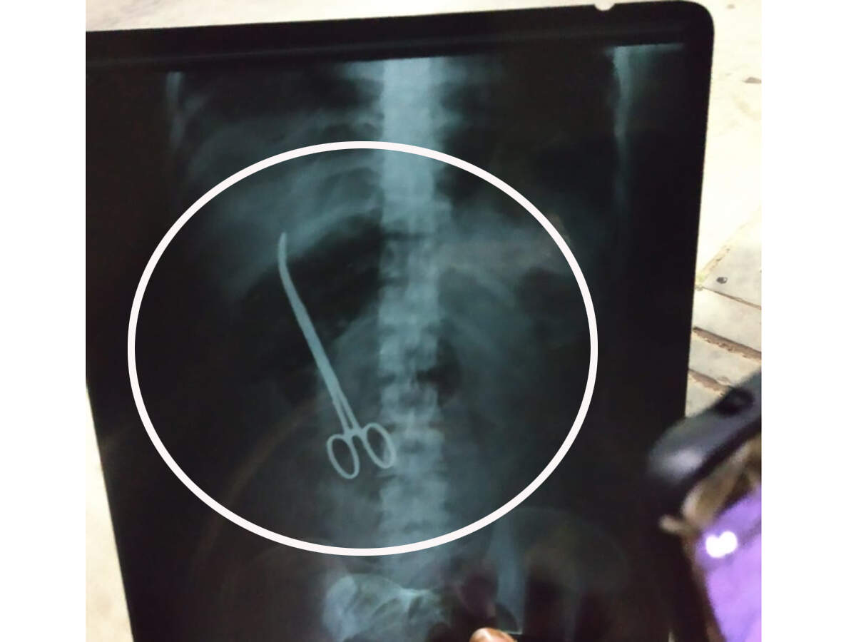 Shocking! Doctors leave scissors in patient's stomach during surgery