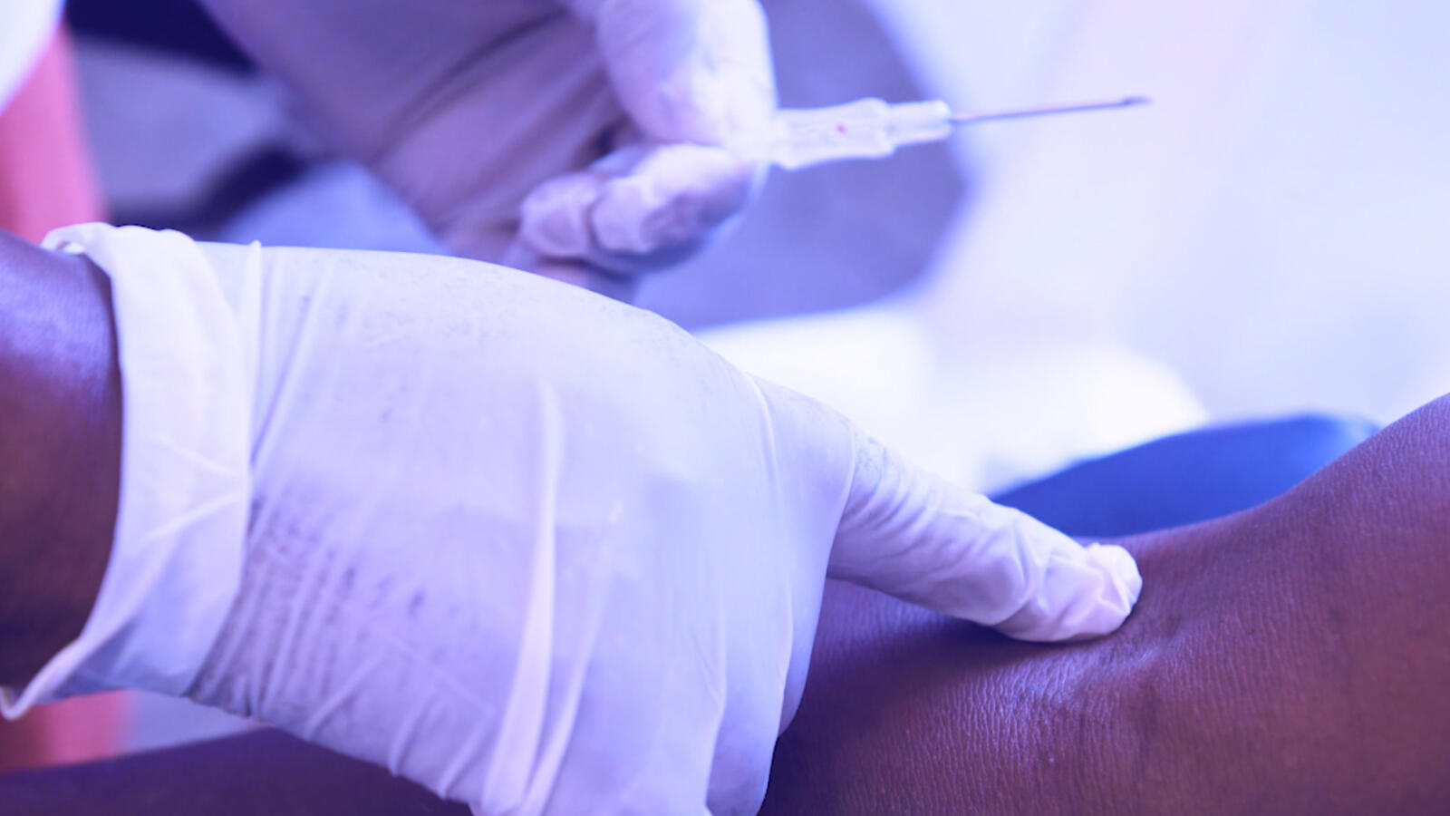 First human blood transfusion performed in 1818