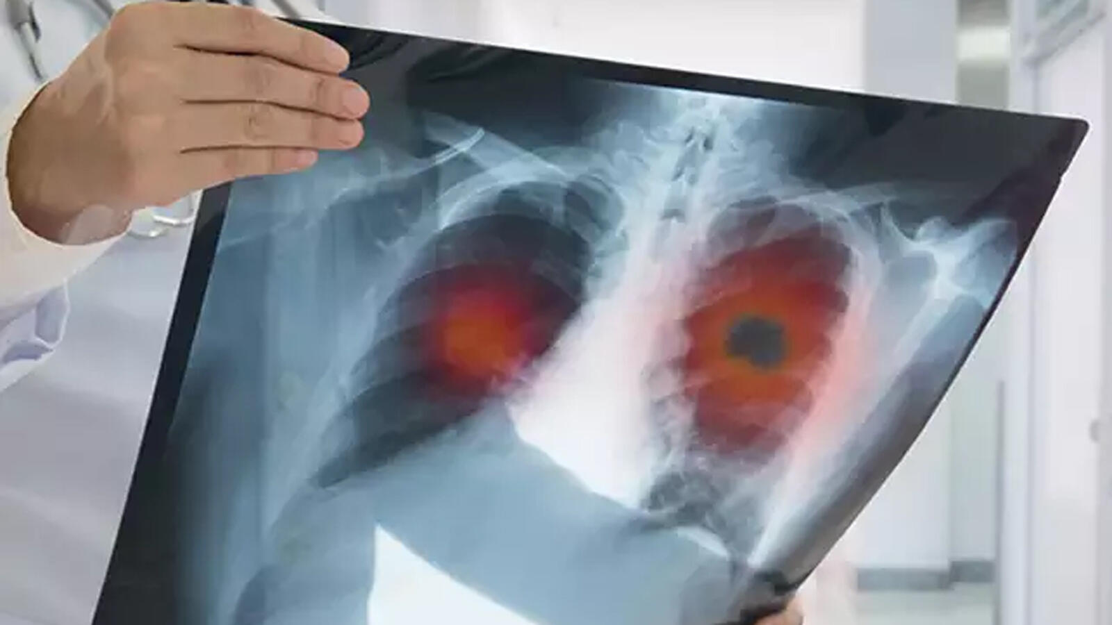 50th Union World Conference on Lung Health to begin on Oct 30