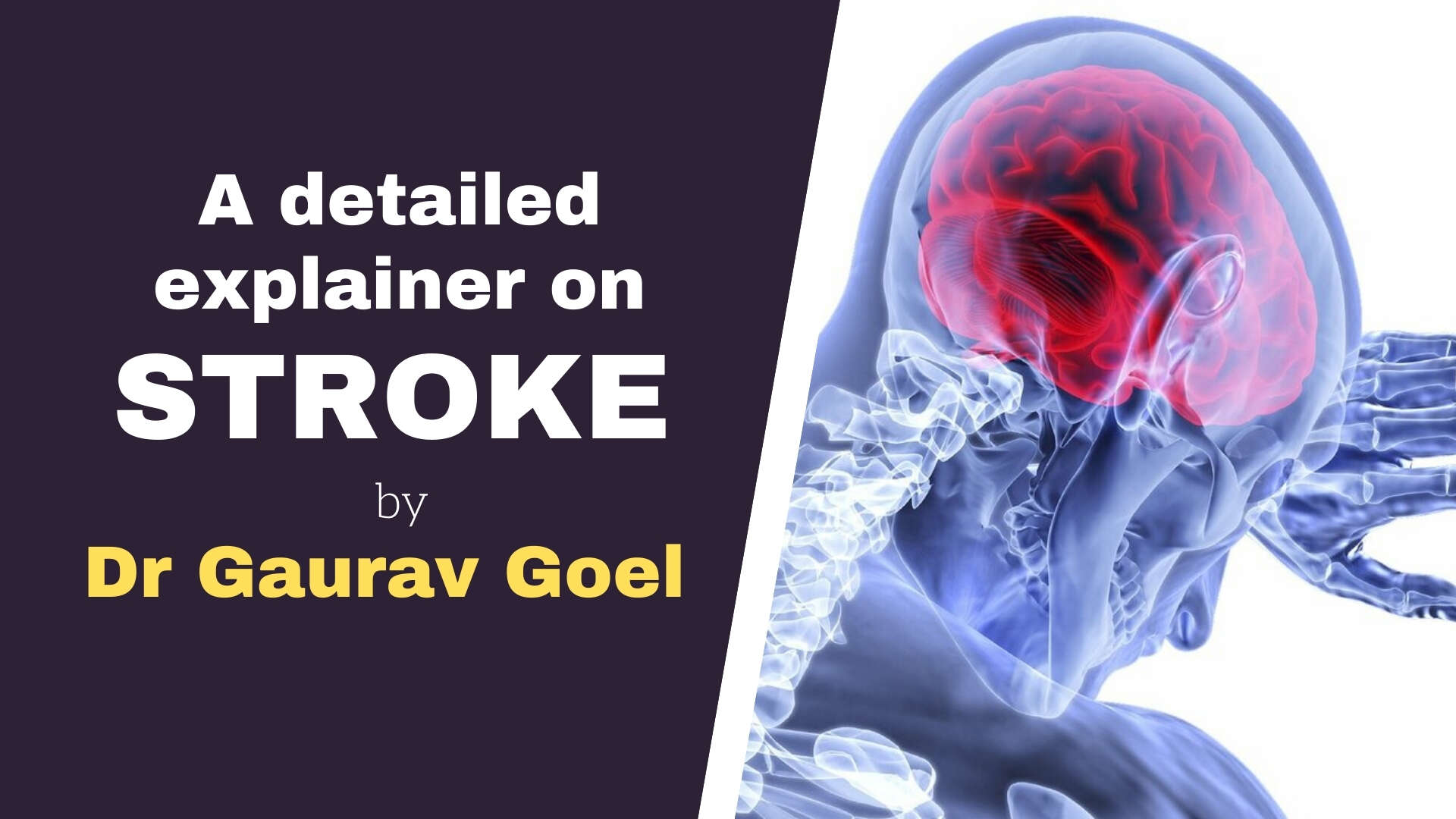 A detailed explainer on stroke by Gaurav Goel