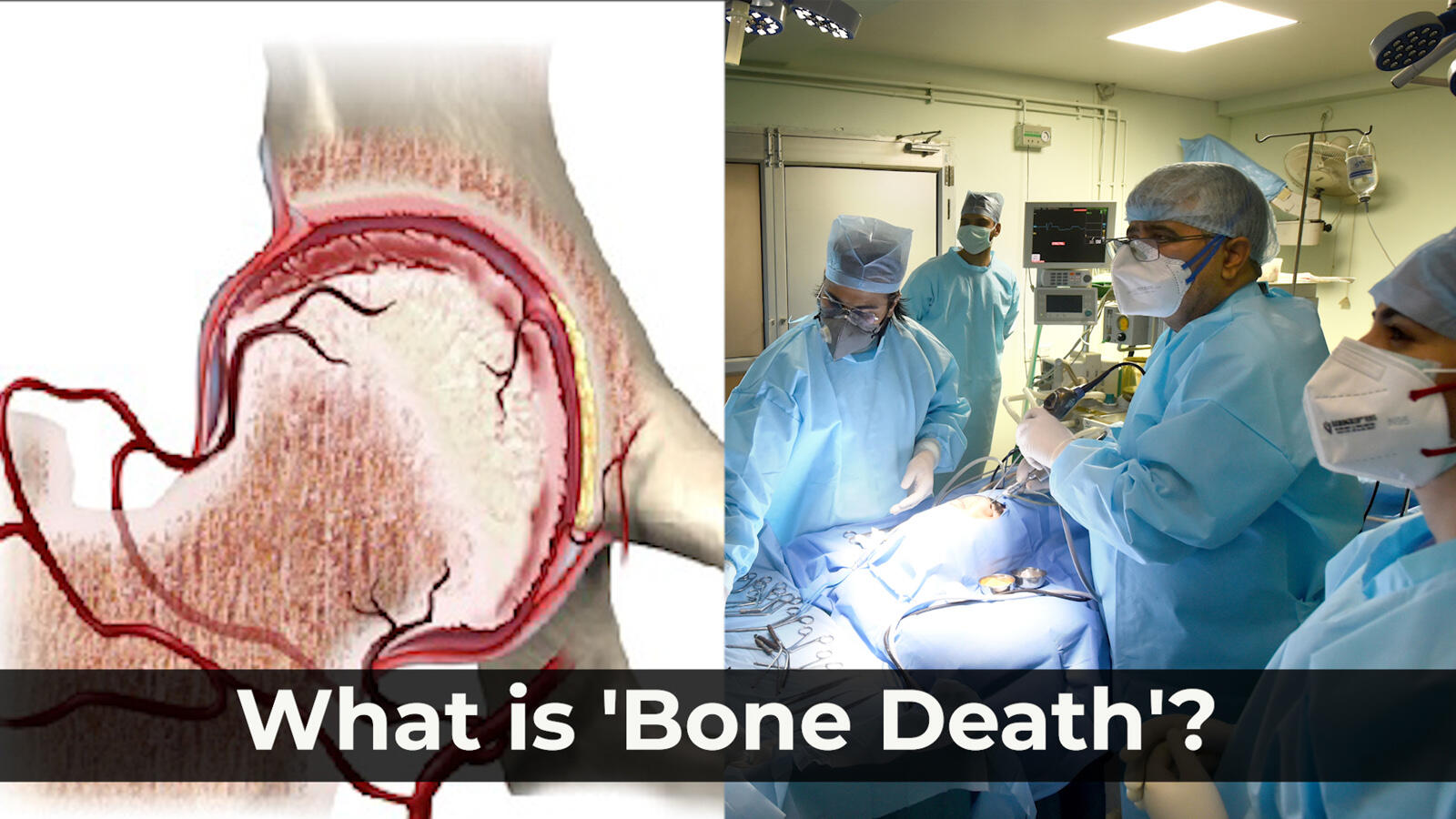 Explained: Why 'bone death' is worrying doctors treating long-Covid ...