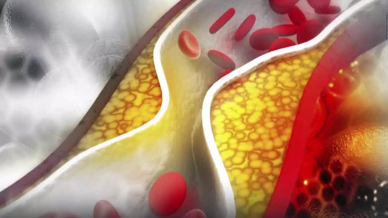 Link between high cholesterol, heart disease 'inconsistent': Study