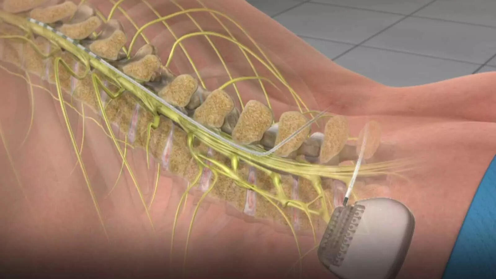 Radiofrequency spinal cord stimulation shows improved longer-lasting ...