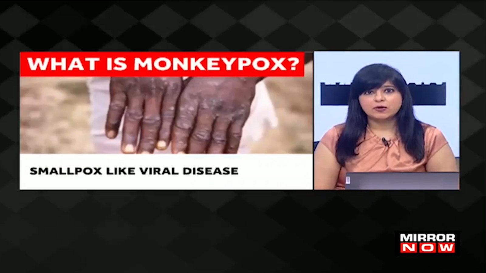 Israel reports first monkeypox case as man returns from Western Europe