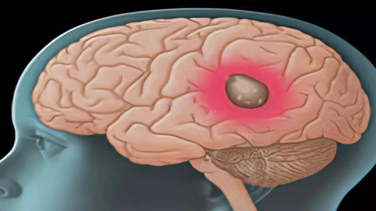 Study reveals surgery may be avoided for children with rare skull tumour