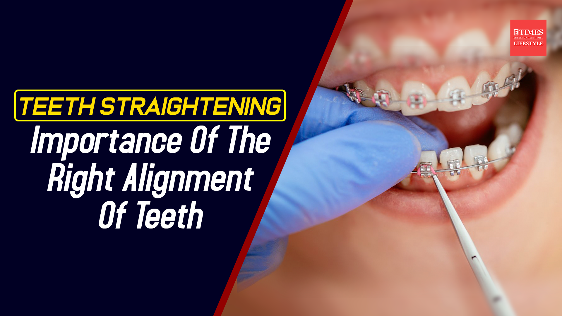 Teeth straightening: Importance of the right alignment of teeth