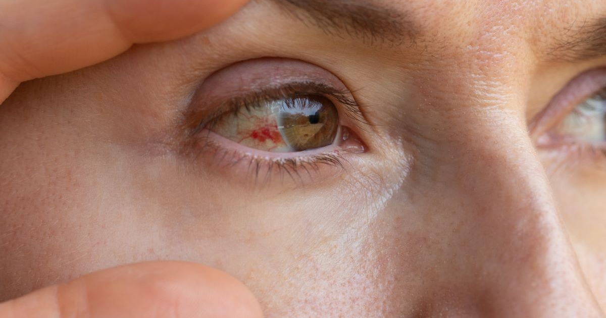 Crimean-Congo haemorrhagic fever explainer: Deadly eye-bleeding virus which can kill up to a ...