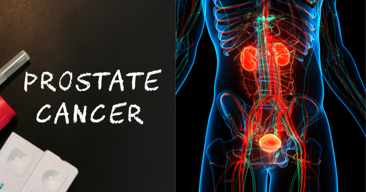 Prostate Cancer Minor Signs That Are Early Warning Symptoms Of The Disease