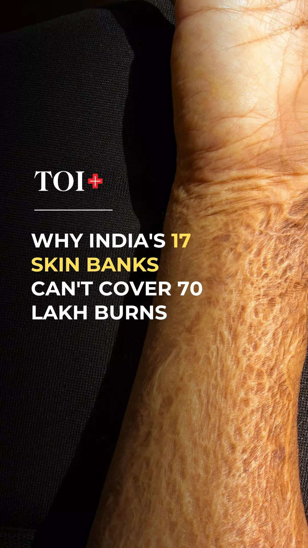 Lakhs of burn injuries every year, but India only has 17 skin banks