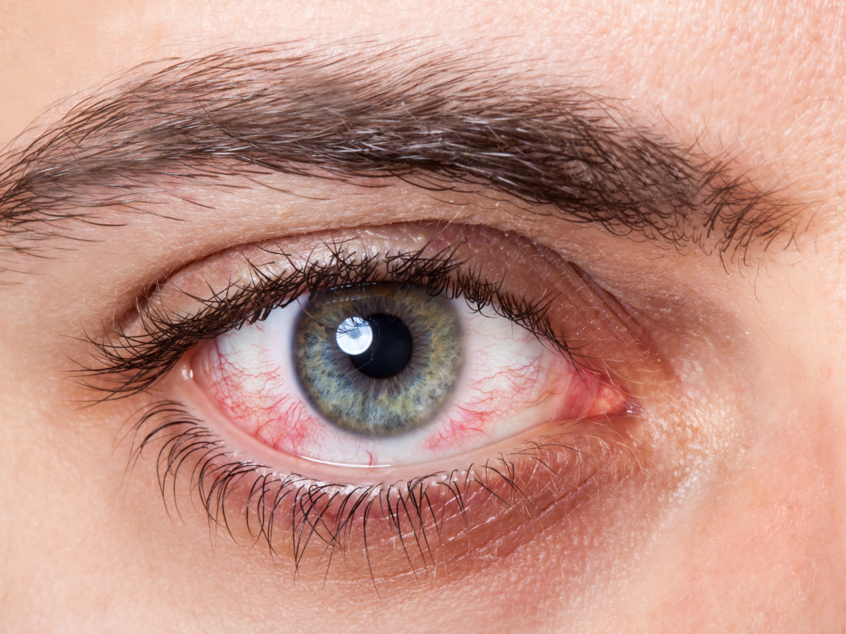 Stroke Painless Warning Sign In The Eyes RB Webcity