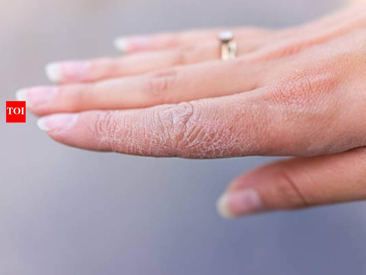 dry knuckles symptom