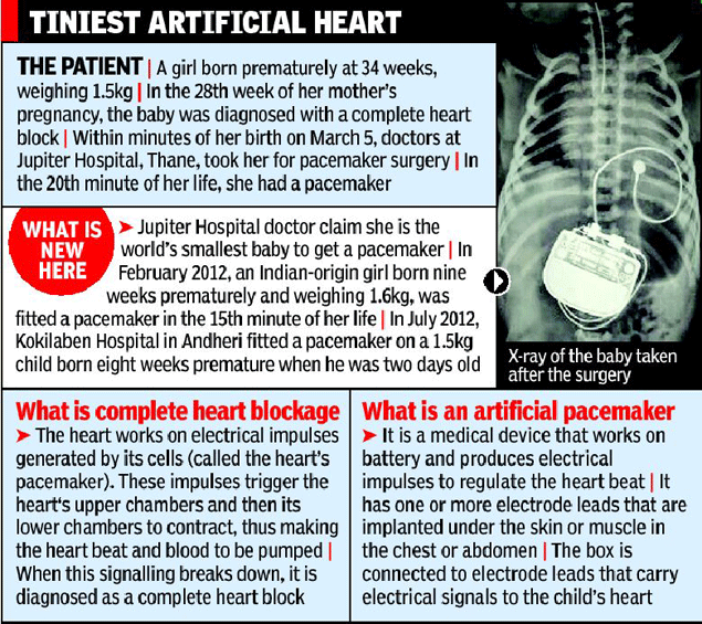Thane girl gets a pacemaker 20 minutes after birth | Mumbai News ...