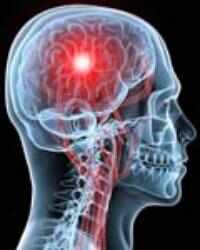 Raising awareness of brain '˜attack'