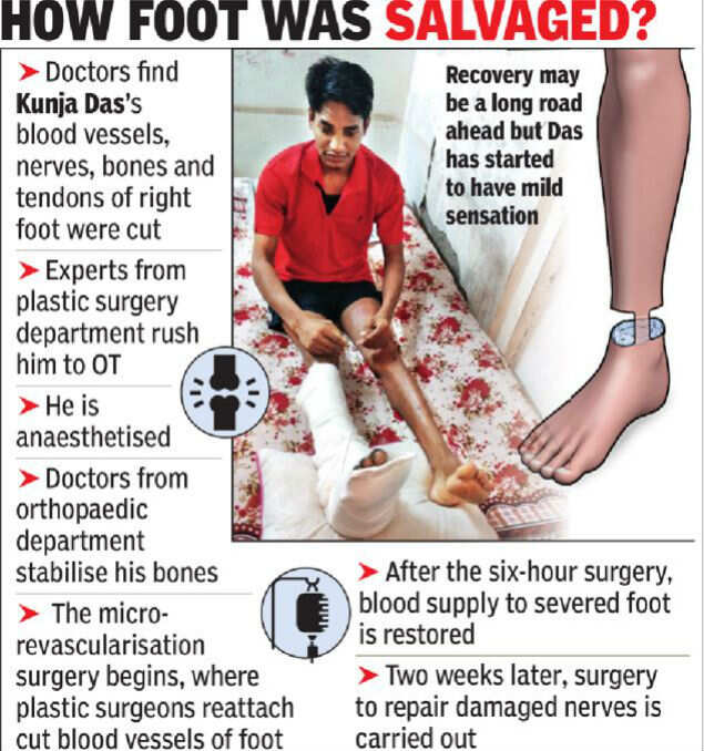 Mumbai doctors reattach foot sliced in mishap in 6-hour surgery ...