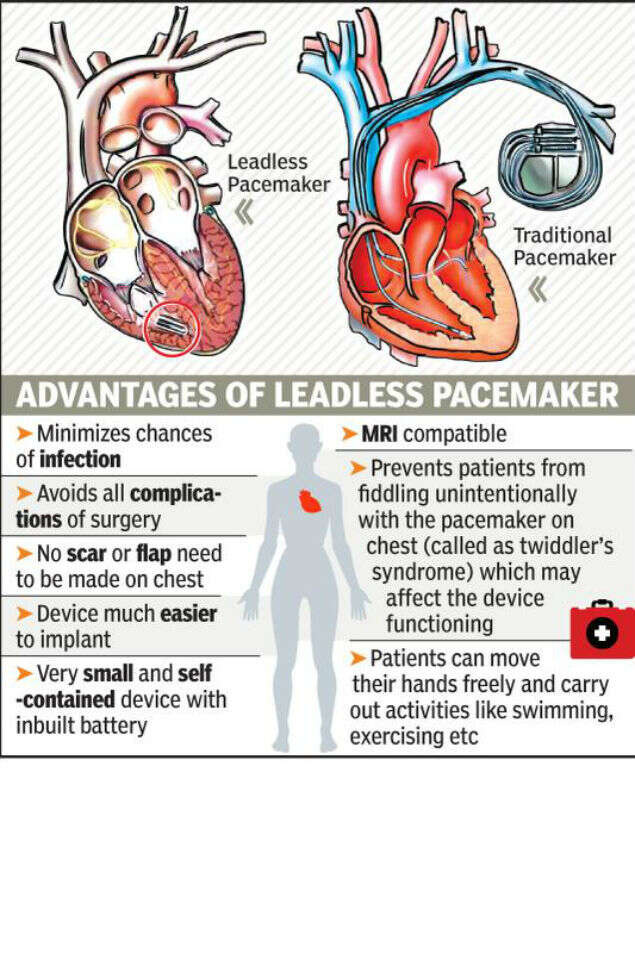 82-year-old man first from Central India to get leadless pacemaker ...