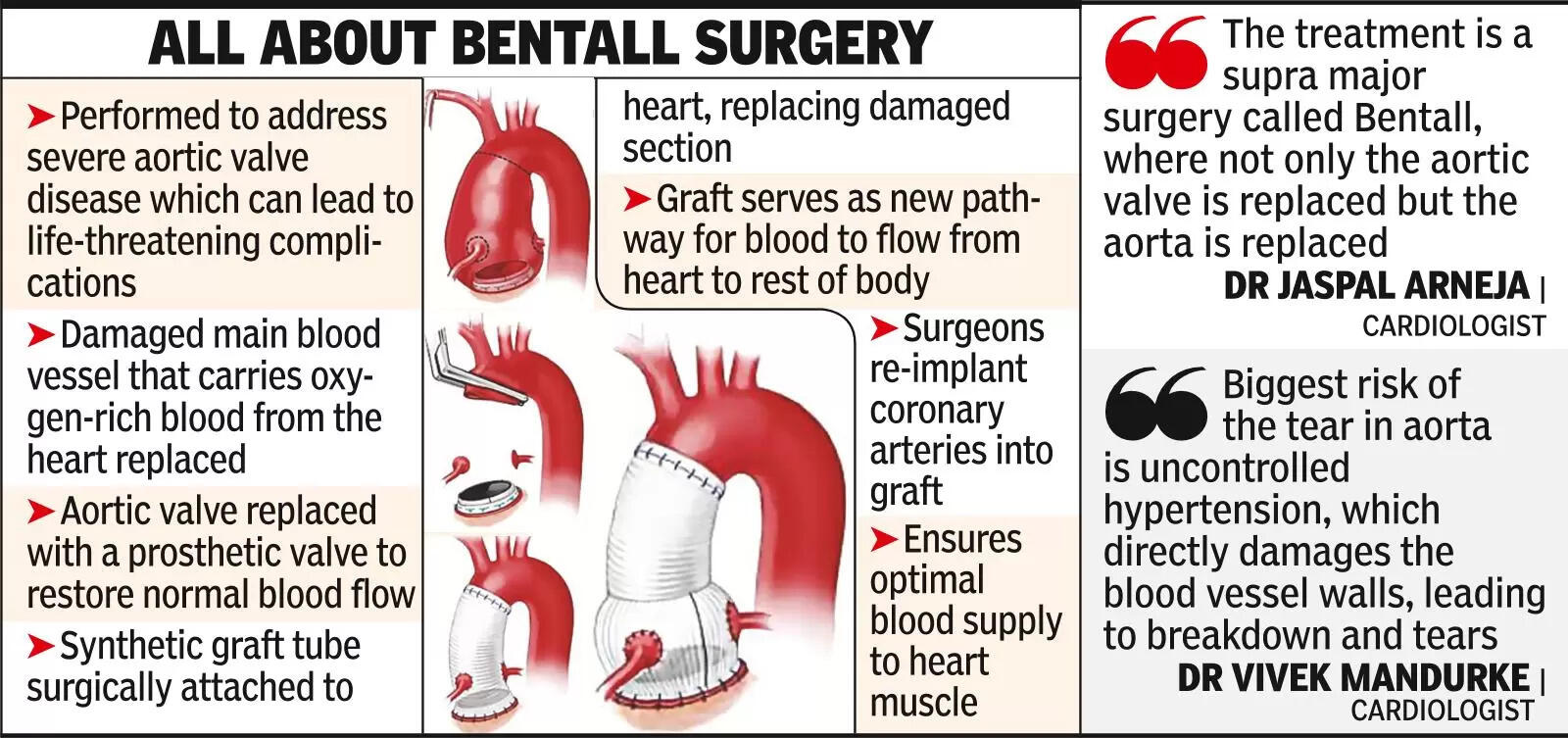 Docs Perform Complex, High Risk Bentall Surgery On Five Patients ...