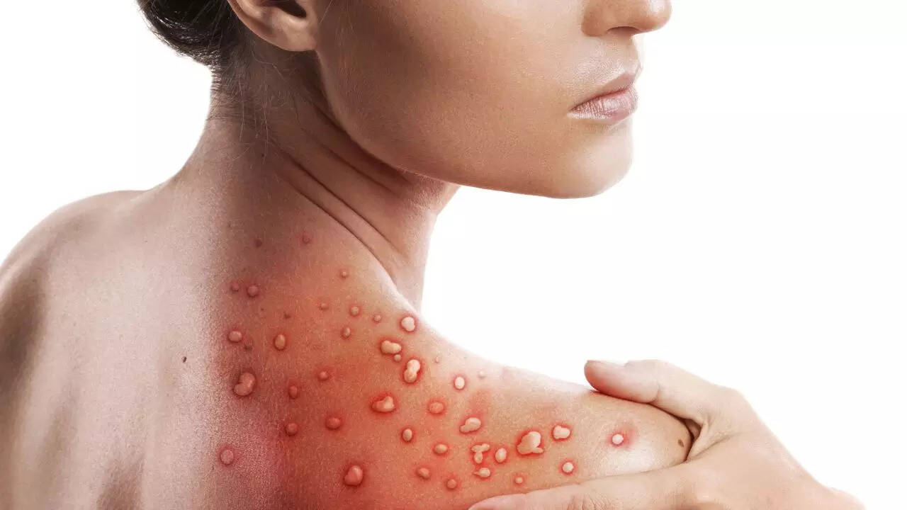 Foods that can secretly trigger skin allergies - Times of India