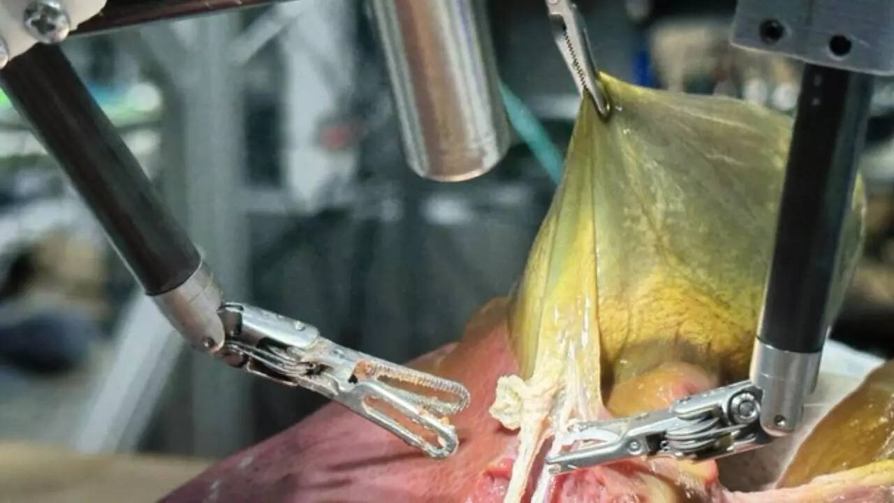 Robot completes groundbreaking gall bladder operation with 100% success ...