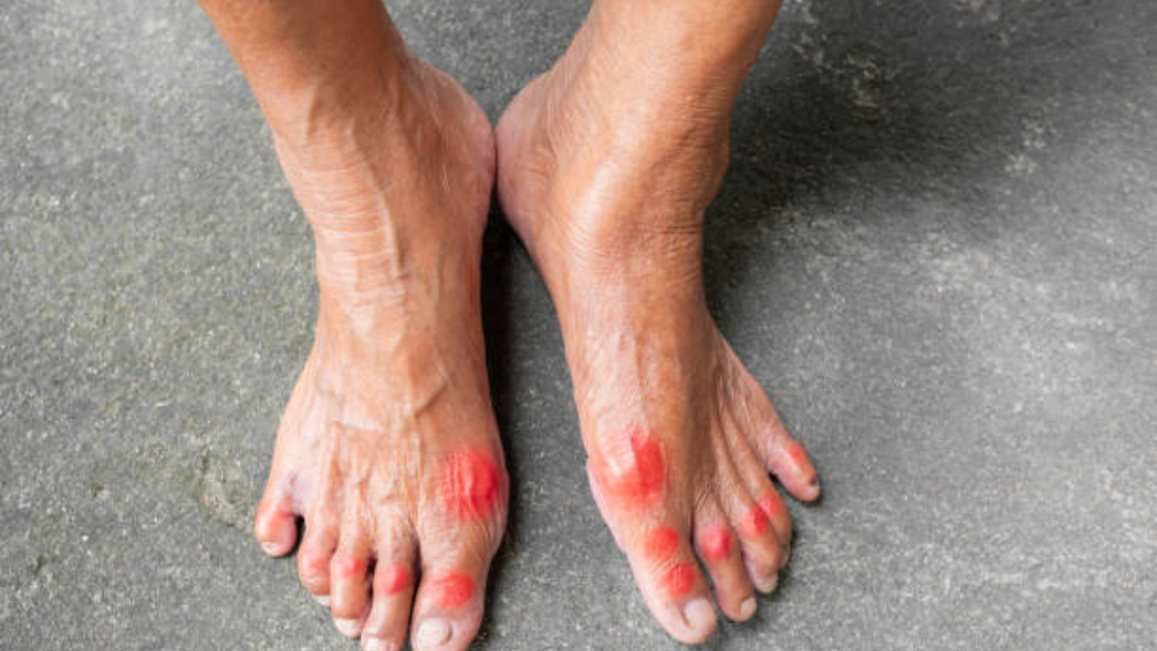 How to know if your uric acid levels are too high without a test ...