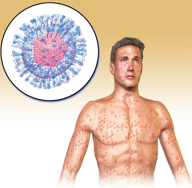 Spike in chickenpox cases among adults in the city