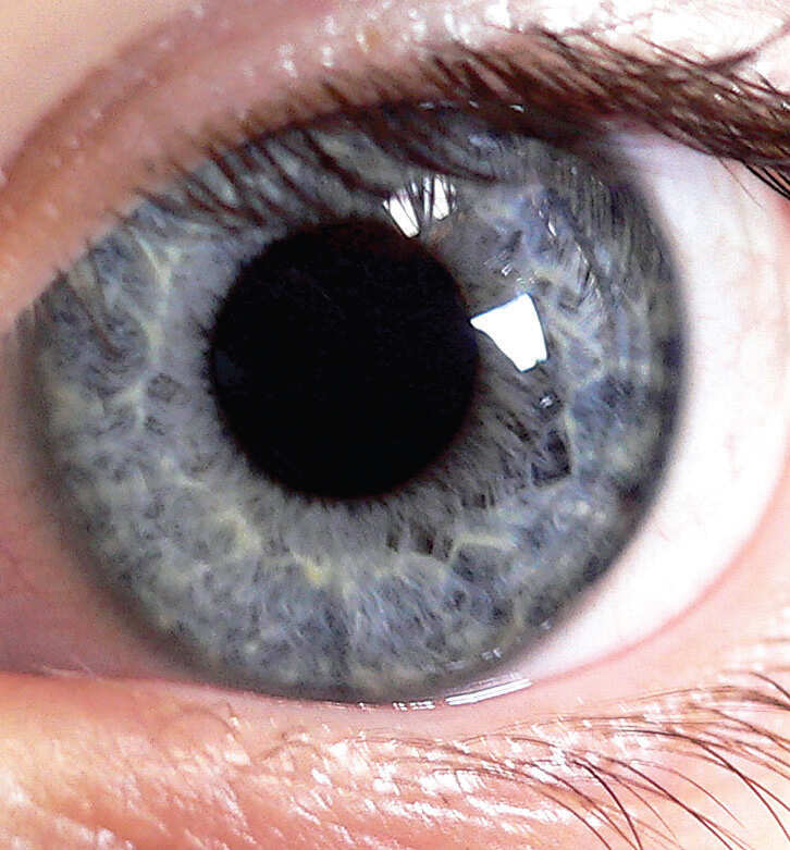 After 10 yrs, woman regains sight due to rare tooth-in-the-eye surgery