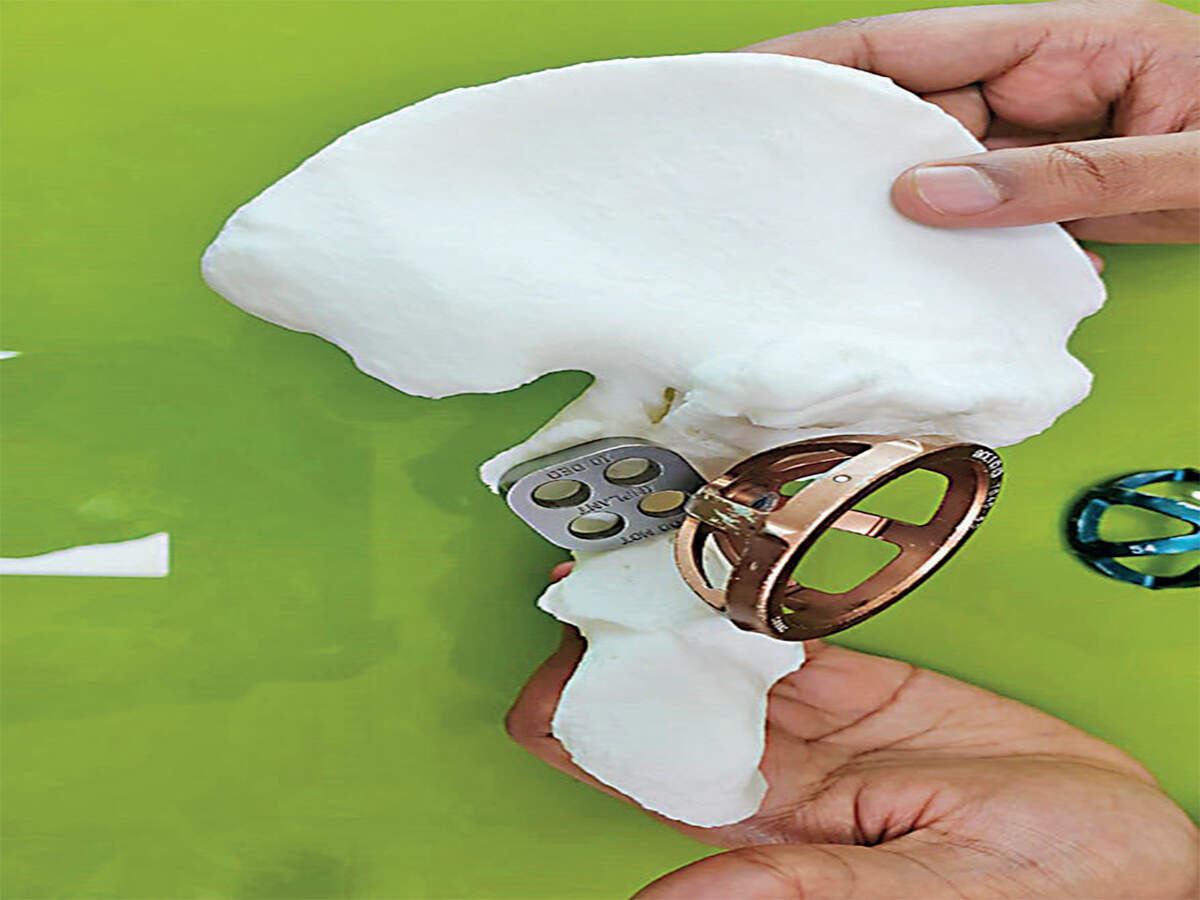 Bengaluru: 38-year-old man gets 3D-printed hip transplant at city hospital