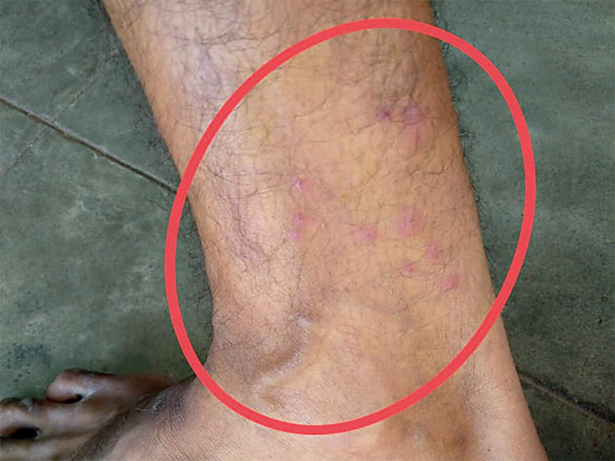 ‘Mysterious’ body rashes alert trekkers