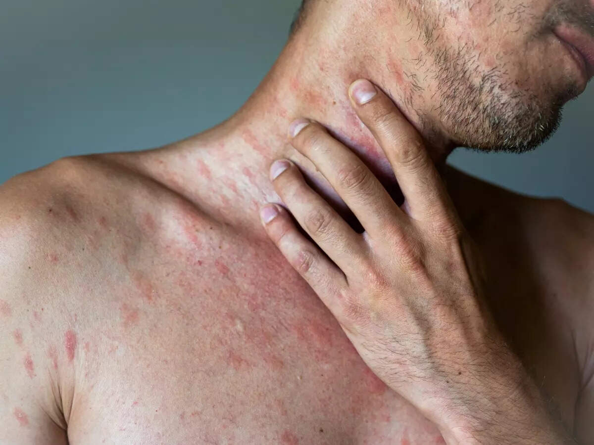 5 facts you need to know about Atopic Dermatitis so we can #ChangeAD ...