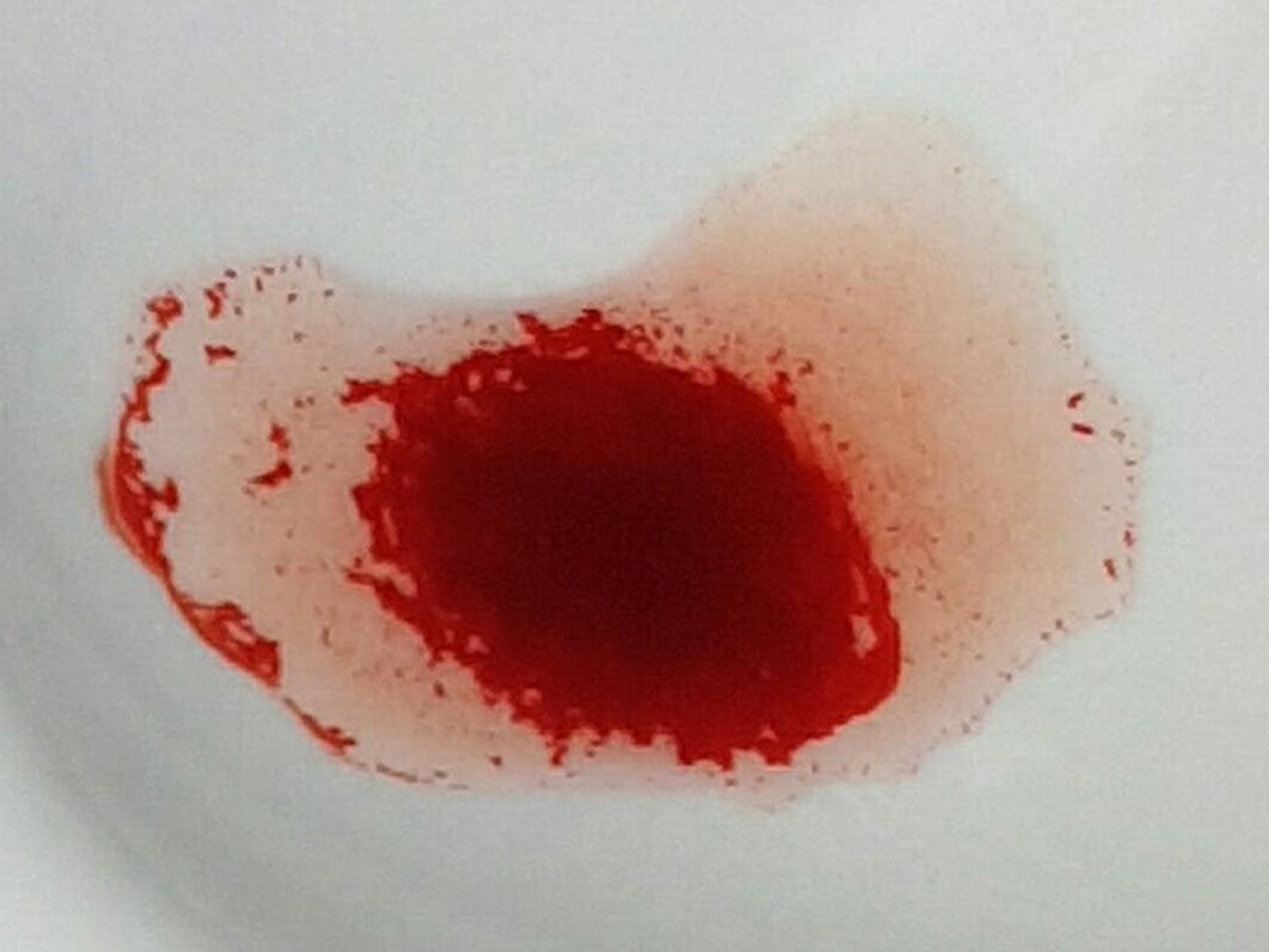 In 1901, Karl Landsteiner mixed blood samples and discovered why ...