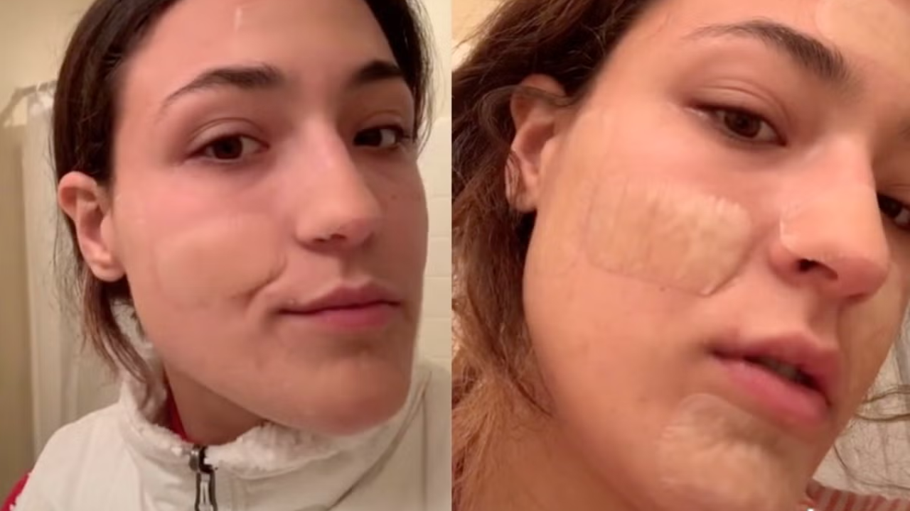 Pimple patches vs hydrocolloid bandages: Which acne treatment works ...