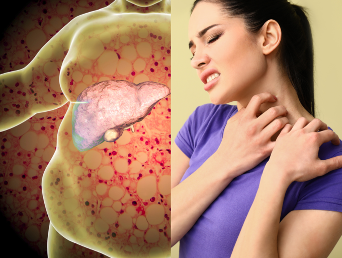 Fatty Liver Symptoms: Fatty liver disease symptoms: THESE 4 changes to ...