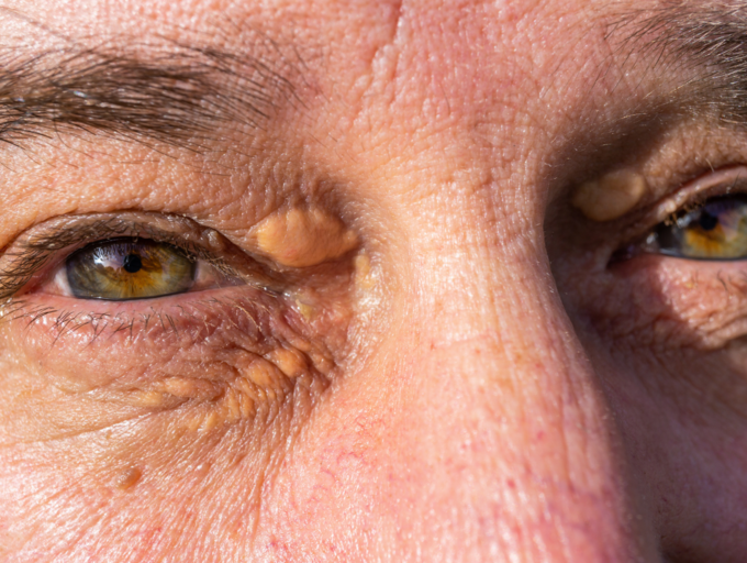 Cholesterol symptoms: THIS warning sign around your eyes could be due ...