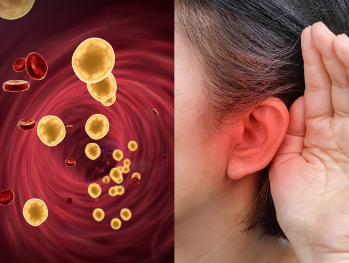 High cholesterol symptoms: THIS lesser-known sign could strike in your ...